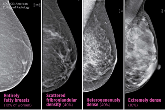 Breast Density and Breast Cancer Risk - The Informed Woman Magazine